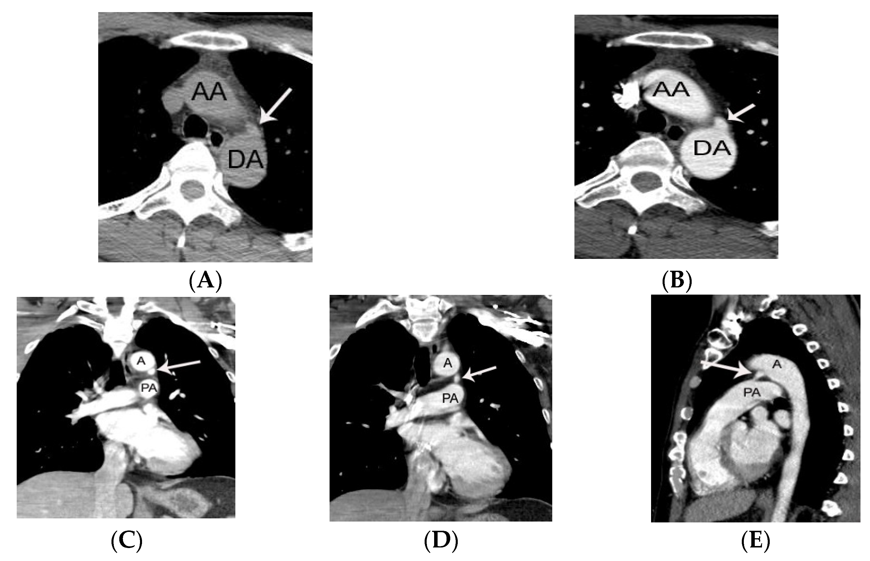 Diagnostics Free Full Text The Patent Ductus Arteriosus In Adults