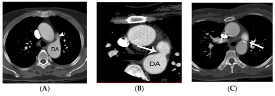 The Patent Ductus Arteriosus in Adults with Special Focus on Role of CT