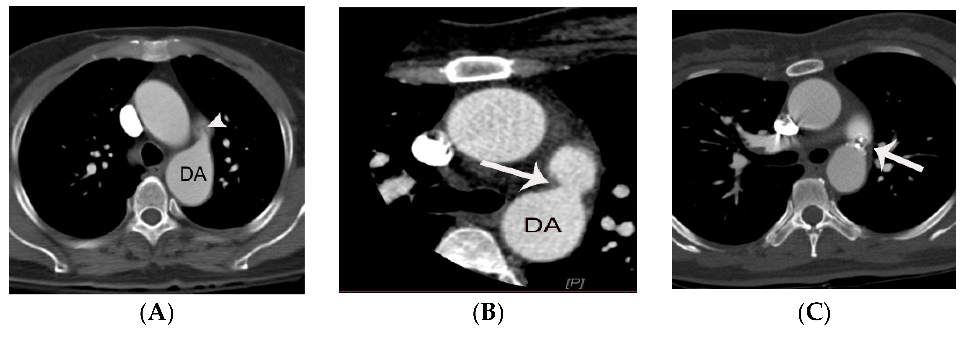 Diagnostics Free Full Text The Patent Ductus Arteriosus In Adults