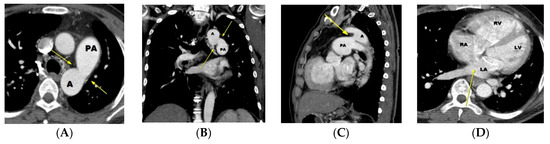 The Patent Ductus Arteriosus in Adults with Special Focus on Role of CT