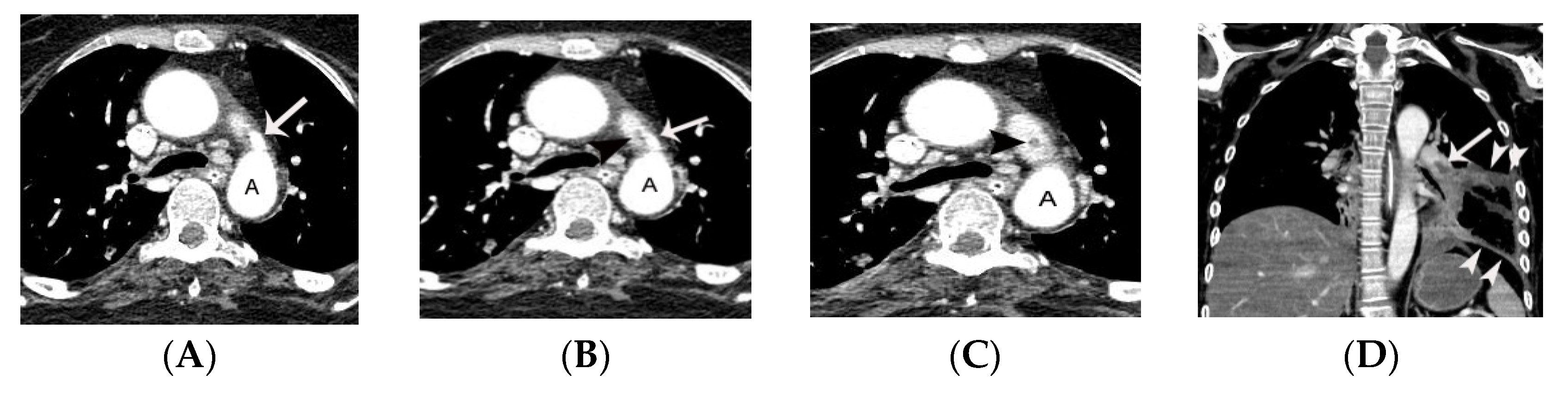Diagnostics Free Full Text The Patent Ductus Arteriosus In Adults