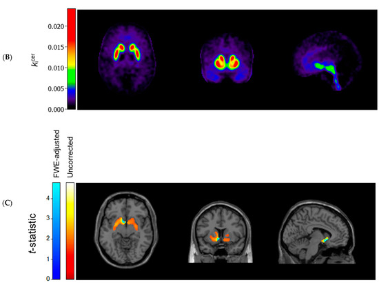 Cerebral [18F]-FDOPA Uptake in Autism Spectrum Disorder and Its ...