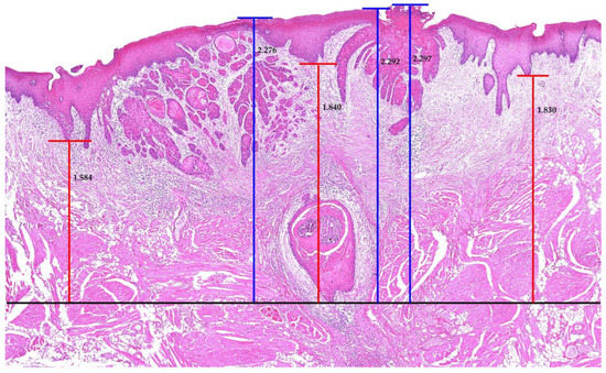 Evaluation of Depth of Invasion and Tumor Thickness as a Prognostic ...