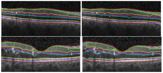 Diagnostics | Special Issue : Artificial Intelligence in Eye Disease