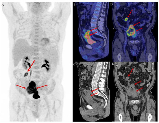 18F-FDG PET/CT in a Case of Urothelial Carcinoma in the Urachus ...