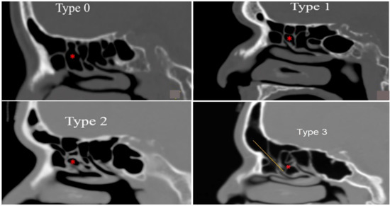 The Effects of Suprabullar Pneumatization on the Orientation of Its ...