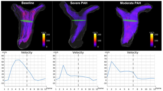 Pulmonary Arteriovenous Pressure Gradient and Time-Averaged Mean ...