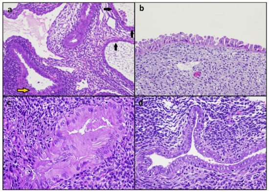 Endometrial Metaplastic/Reactive Changes Coexistent with Endometrial ...
