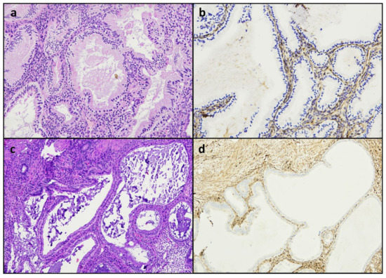Endometrial Metaplastic/Reactive Changes Coexistent with Endometrial ...