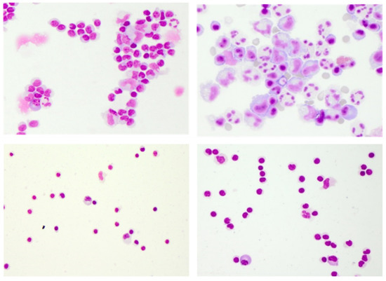 Role and Relevance of Cerebrospinal Fluid Cells in Diagnostics and ...