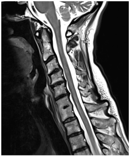 Are Congenital Cervical Block Vertebrae a Risk Factor for Adjacent ...