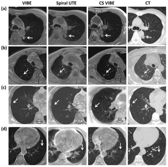 Diagnostics | Free Full-Text | Applying Compressed Sensing Volumetric Interpolated Breath-Hold ...