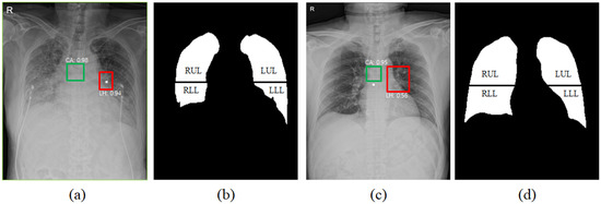 Deep Learning-Based Four-Region Lung Segmentation in Chest Radiography ...
