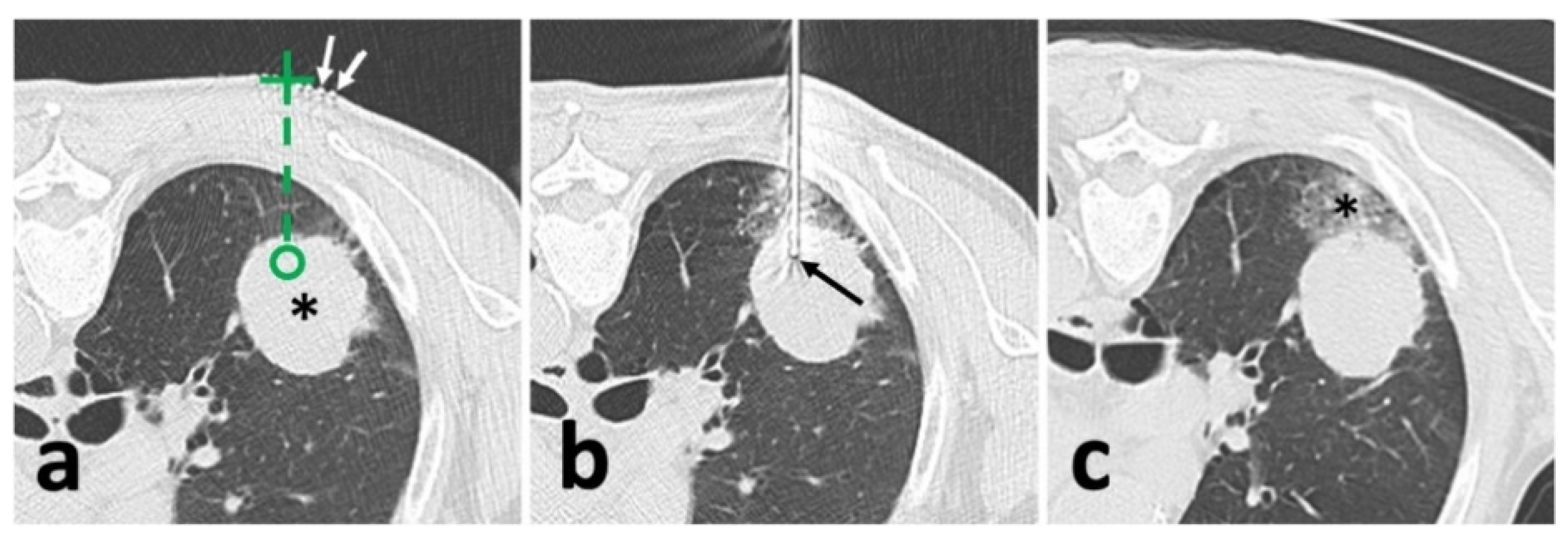 Cone Beam Ct Imaging For Bronchoscopy A Technical Review - The Best ...