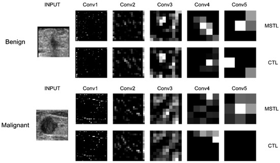 A Novel Multistage Transfer Learning for Ultrasound Breast Cancer Image ...