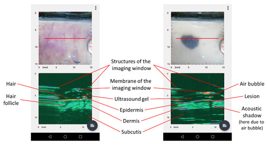 Preliminary Clinical Experience with a Novel Optical–Ultrasound Imaging ...