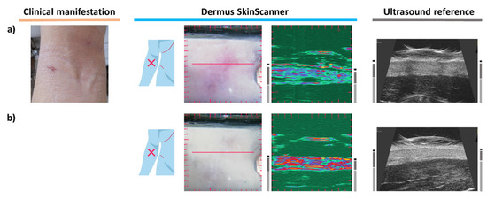 Preliminary Clinical Experience with a Novel Optical–Ultrasound Imaging ...