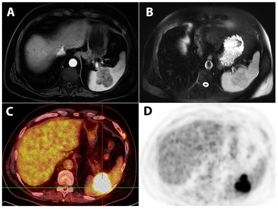 Isolated Splenic Metastasis of Primary Lung Cancer Presented as ...