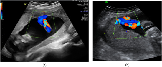 Velamentous Cord Insertion Ultrasound