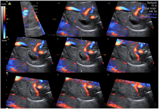 Clinically Relevant Prenatal Ultrasound Diagnosis of Umbilical Cord ...
