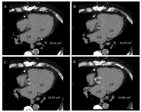 Diagnostics | Free Full-Text | Association of Left Atrial Size Measured ...