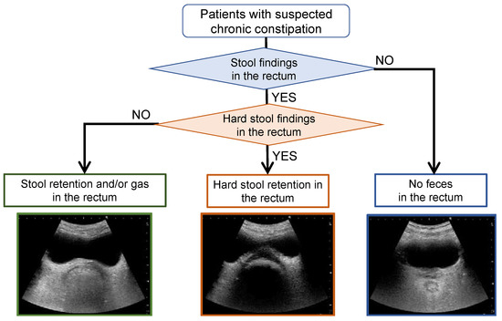Expert Consensus Document: Diagnosis for Chronic Constipation with ...