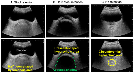 Expert Consensus Document: Diagnosis for Chronic Constipation with ...
