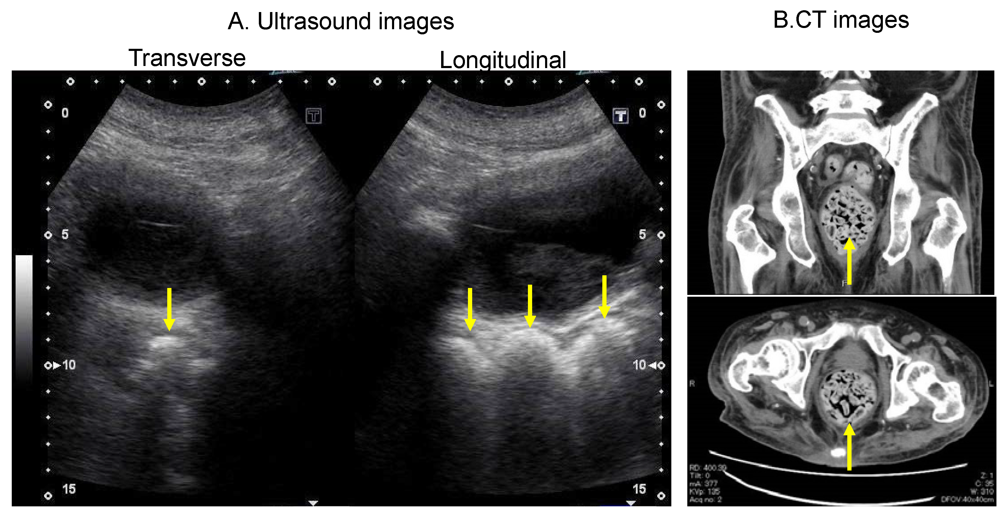X Ray Of Severe Constipation