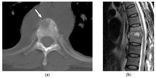 A Review of Posteromedial Lesions of the Chest Wall: What Should a ...