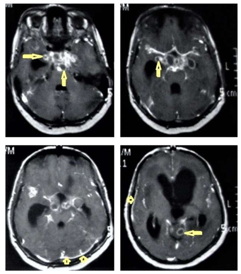 The Diagnostic Deceiver: Radiological Pictorial Review of Tuberculosis