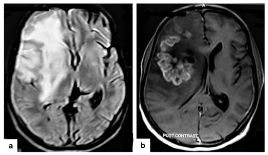The Diagnostic Deceiver: Radiological Pictorial Review of Tuberculosis
