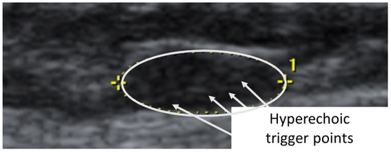 Ultrasound Confirmation of the Multiple Loci Hypothesis of the ...