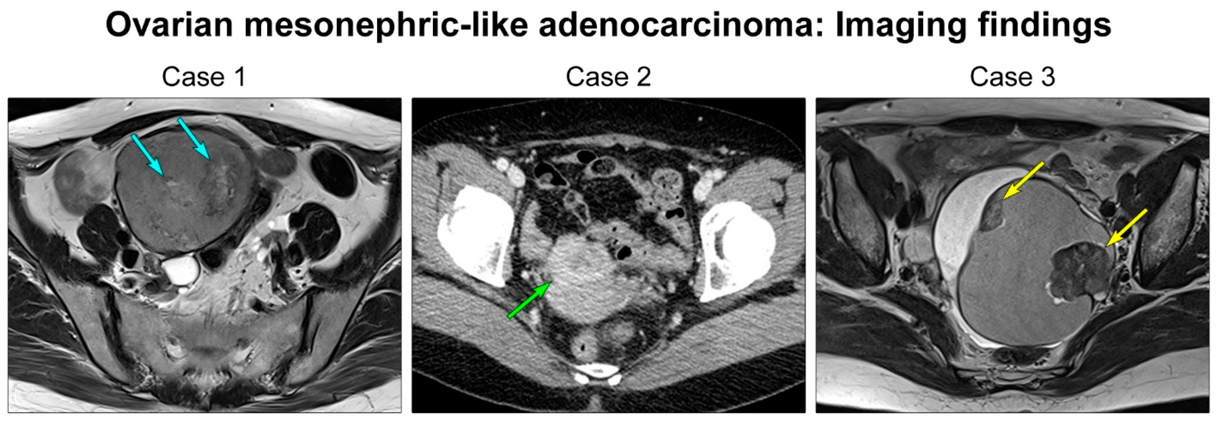 Diagnostics Free Full Text Mesonephric Like Adenocarcinoma Of The Ovary Clinicopathological