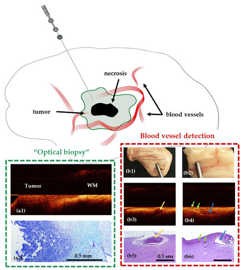 OCT-Guided Surgery for Gliomas: Current Concept and Future Perspectives