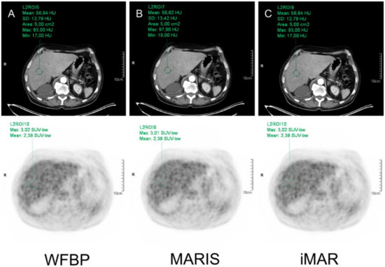 Beam Hardening Artifact Pet Ct - The Best Picture Of Beam