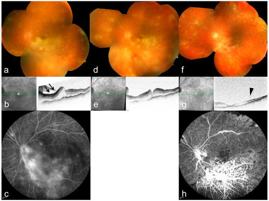 Acute Retinal Necrosis: Signs, Treatment, Complications and Outcome