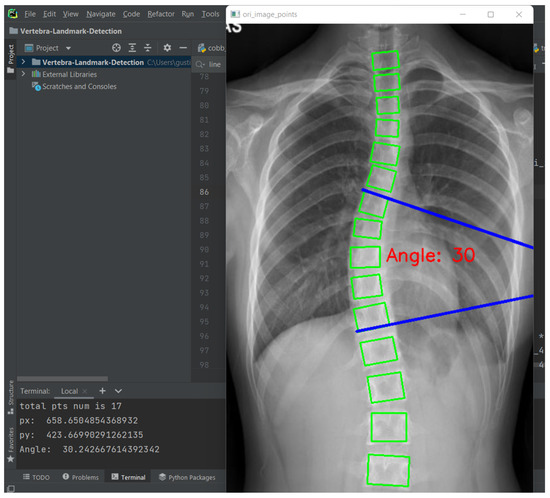 Automated Cobb Angle Measurement for Adolescent Idiopathic Scoliosis Using Convolutional Neural ...