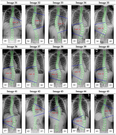Automated Cobb Angle Measurement for Adolescent Idiopathic Scoliosis ...