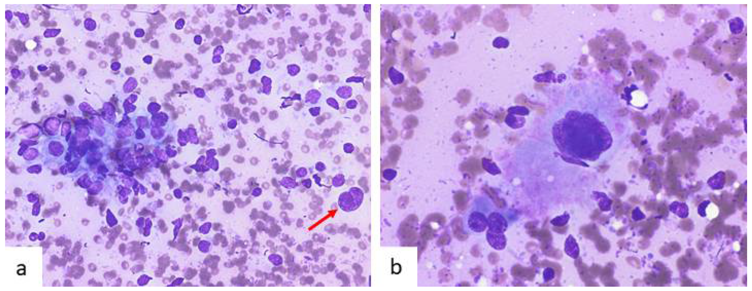 A Cytological Review of Follicular Dendritic Cell-Derived Tumors with ...