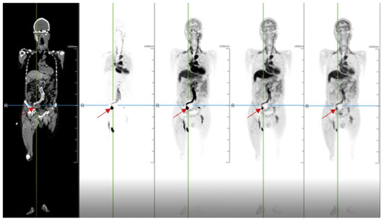 Advantages and Applications of Total-Body PET Scanning
