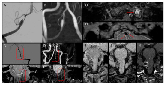 Diagnostic Performance of High-Resolution Vessel Wall Magnetic Resonance Imaging and Digital ...