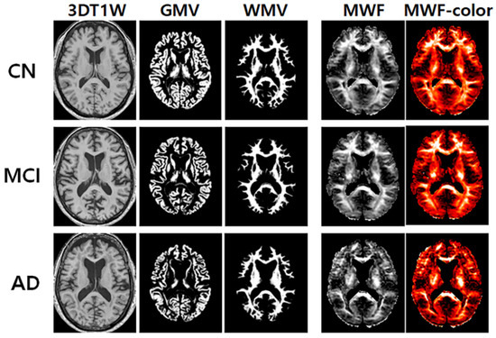 Myelin-Weighted Imaging Presents Reduced Apparent Myelin Water in Patients with Alzheimer’s Disease