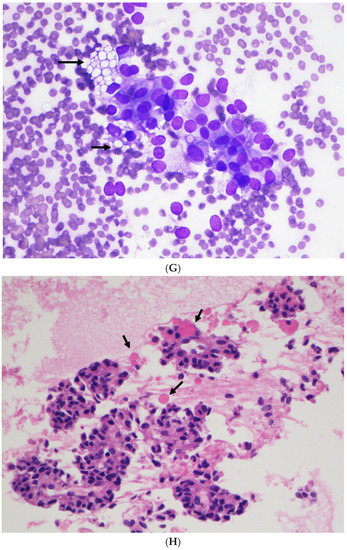 Cytological Diagnosis of Pancreatic Solid-Pseudopapillary Neoplasm: A ...