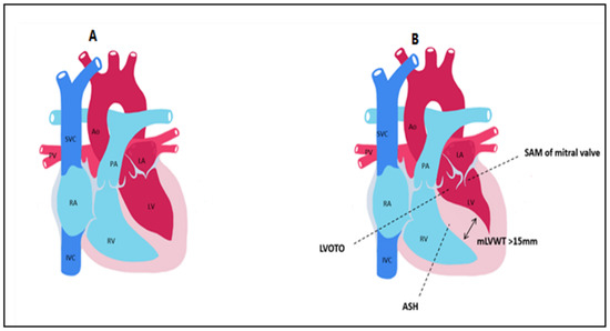Anatomical-MRI Correlations in Adults and Children with Hypertrophic ...
