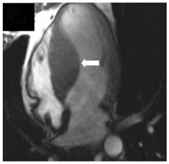 Anatomical-MRI Correlations in Adults and Children with Hypertrophic ...