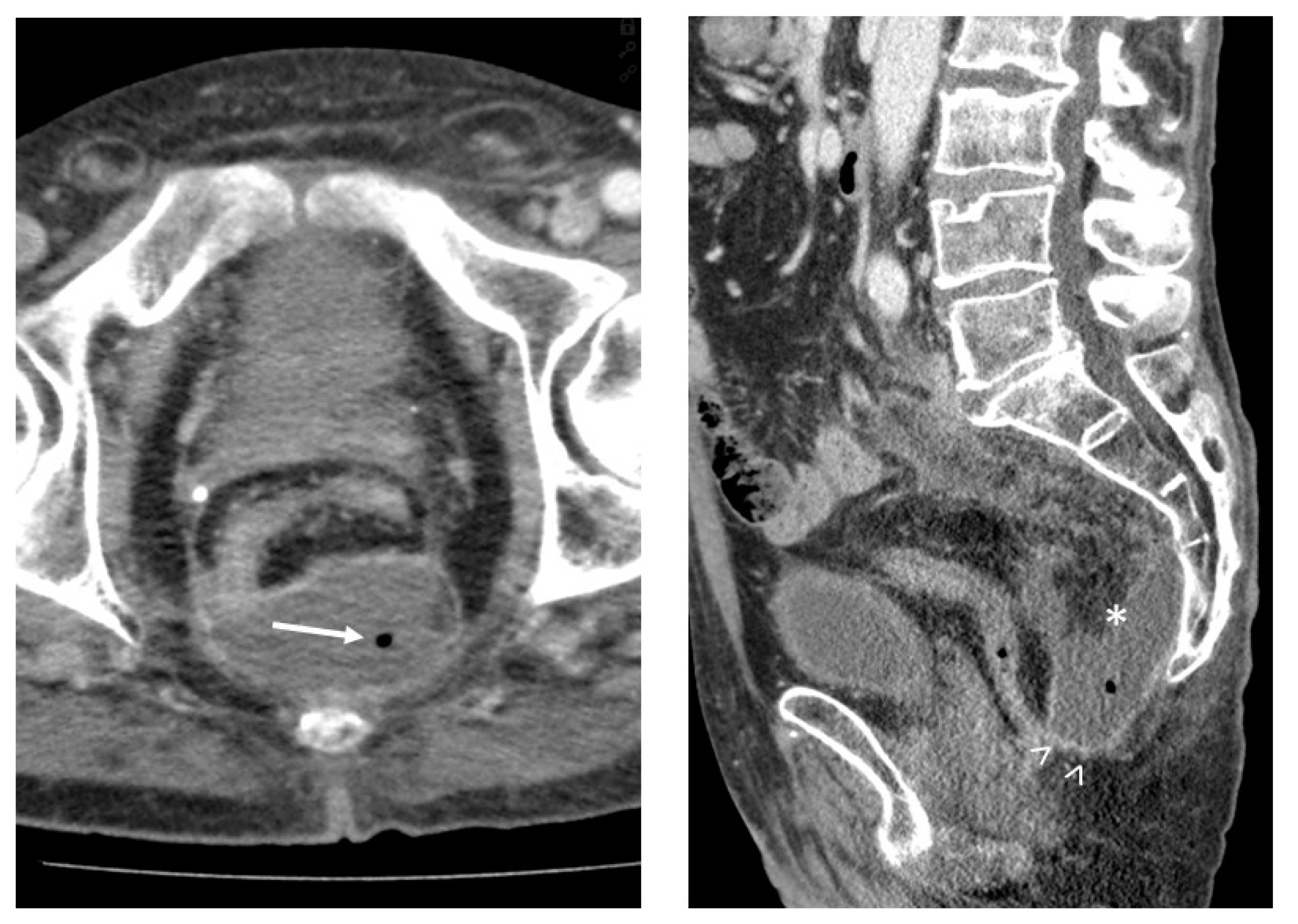 Imaging and Clinical Parameters for Distinction between Infected and ...