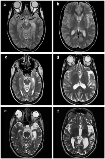 MRI in Late-Onset Rasmussen Encephalitis: A Long-Term Follow-Up Study