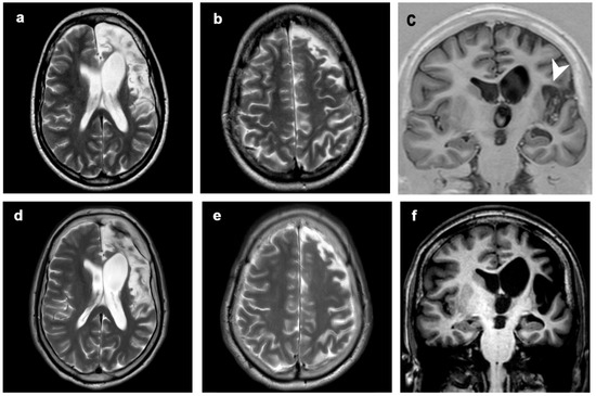 MRI in Late-Onset Rasmussen Encephalitis: A Long-Term Follow-Up Study