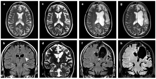 MRI in Late-Onset Rasmussen Encephalitis: A Long-Term Follow-Up Study