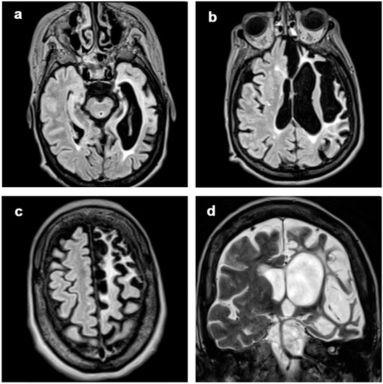 MRI in Late-Onset Rasmussen Encephalitis: A Long-Term Follow-Up Study
